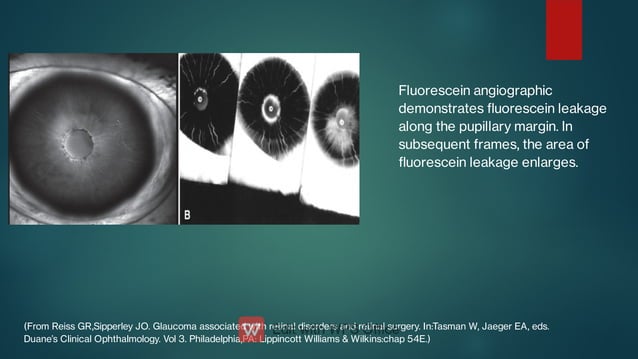Neovascular glaucoma retinal aspects.... | PPT