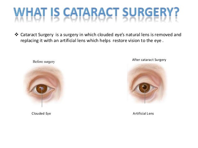 Cataracts Removal