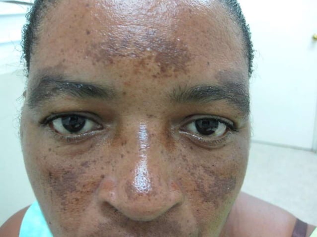Pregnancy Dermatoses | PPT
