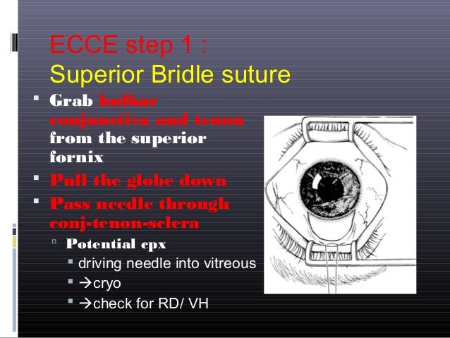 Nw2012 cataract surgery11