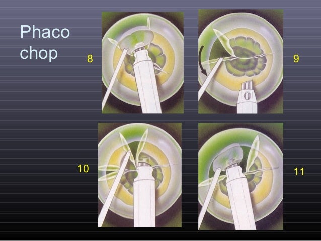 Nw2012 cataract surgery11