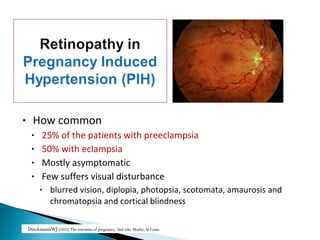 Nw2013 retinopathies inpregnancyfinal | PPT