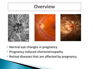 Nw2013 retinopathies inpregnancyfinal | PPT
