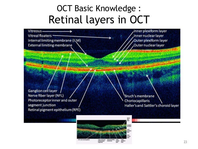 Nw2015 rcopt oct_retina22