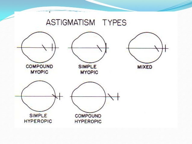 NW2011 Optic of human eye