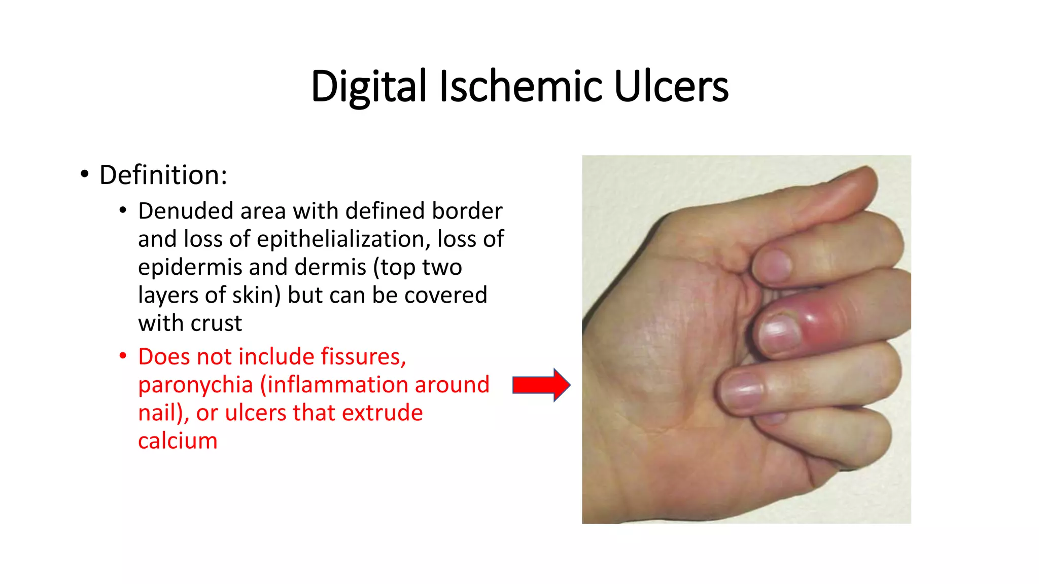 Raynaud Phenomenon and Digital Ulcers in Scleroderma | PPT