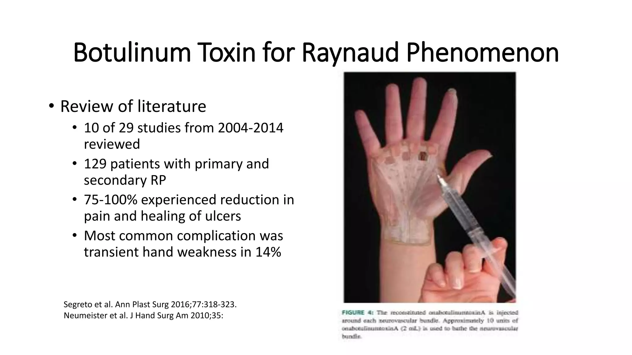 Raynaud Phenomenon and Digital Ulcers in Scleroderma | PPTX