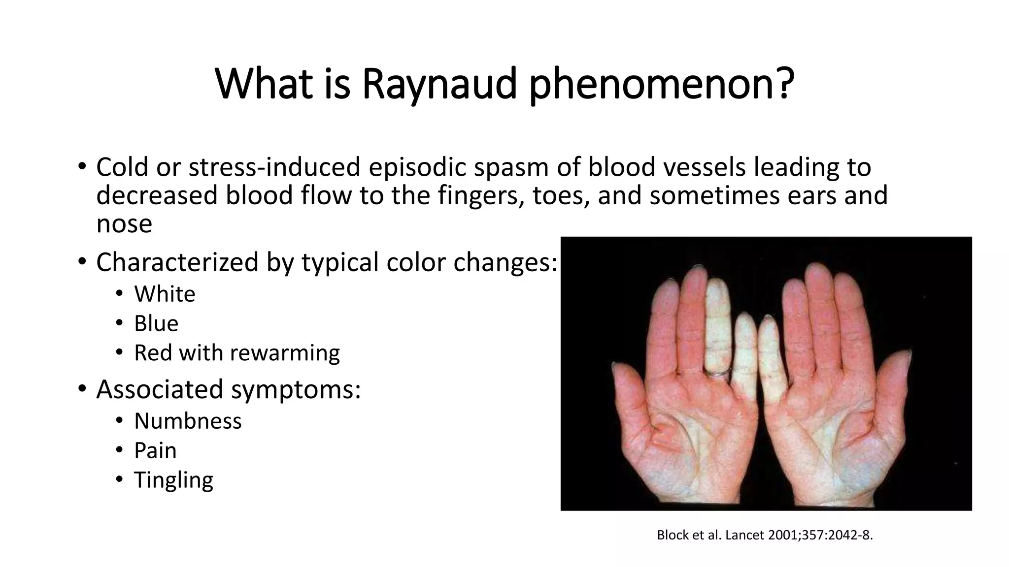 Raynaud Phenomenon and Digital Ulcers in Scleroderma | PPTX