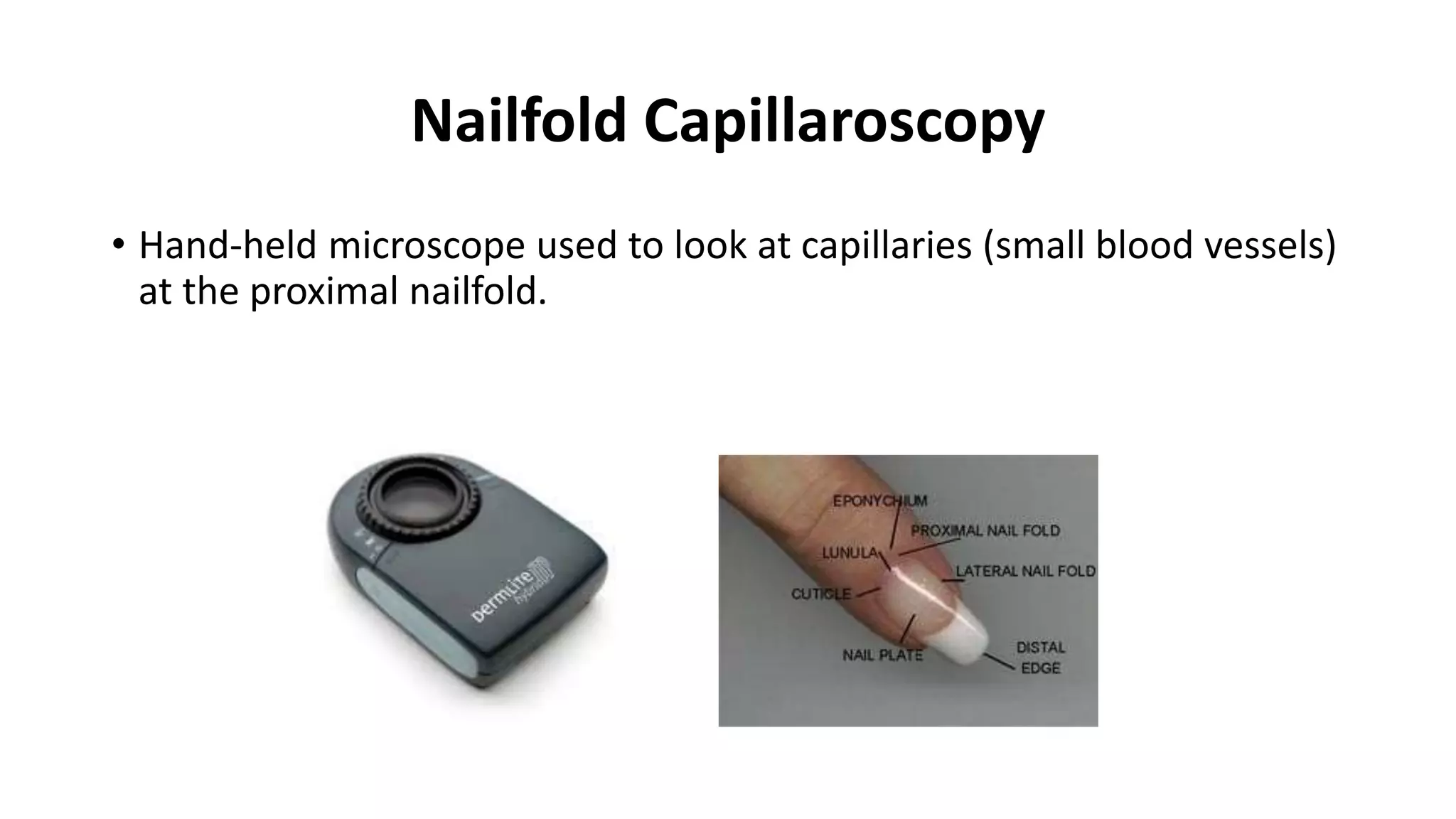 Raynaud Phenomenon and Digital Ulcers in Scleroderma | PPTX