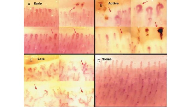 Raynaud Phenomenon and Digital Ulcers in Scleroderma | PPTX
