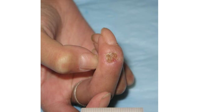 Raynaud Phenomenon and Digital Ulcers in Scleroderma | PPTX