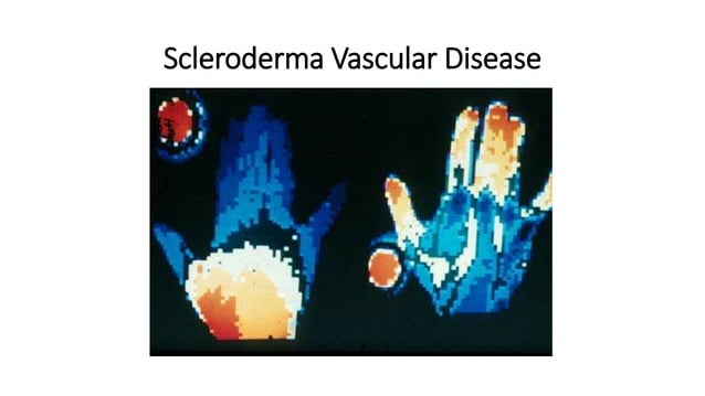 Raynaud Phenomenon and Digital Ulcers in Scleroderma | PPTX