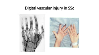Raynaud Phenomenon and Digital Ulcers in Scleroderma | PPTX