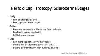 Raynaud Phenomenon and Digital Ulcers in Scleroderma | PPTX
