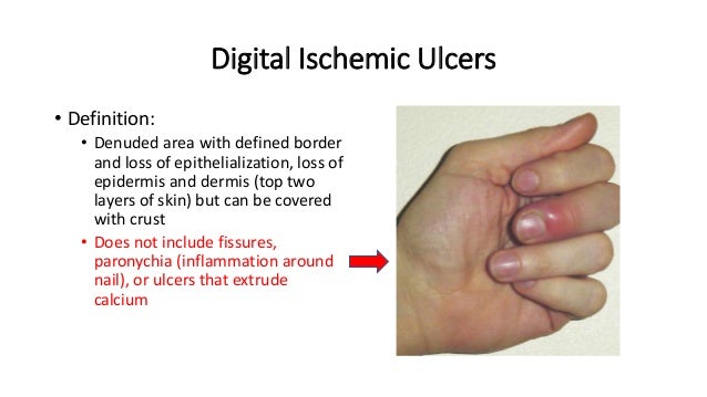 Raynaud Phenomenon and Digital Ulcers in Scleroderma