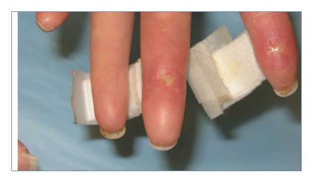 Raynaud Phenomenon and Digital Ulcers in Scleroderma