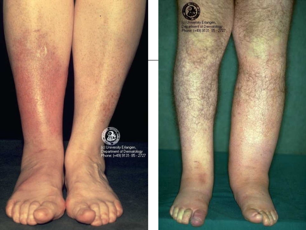 Infections cutanées bactériennes medecine-cours.com