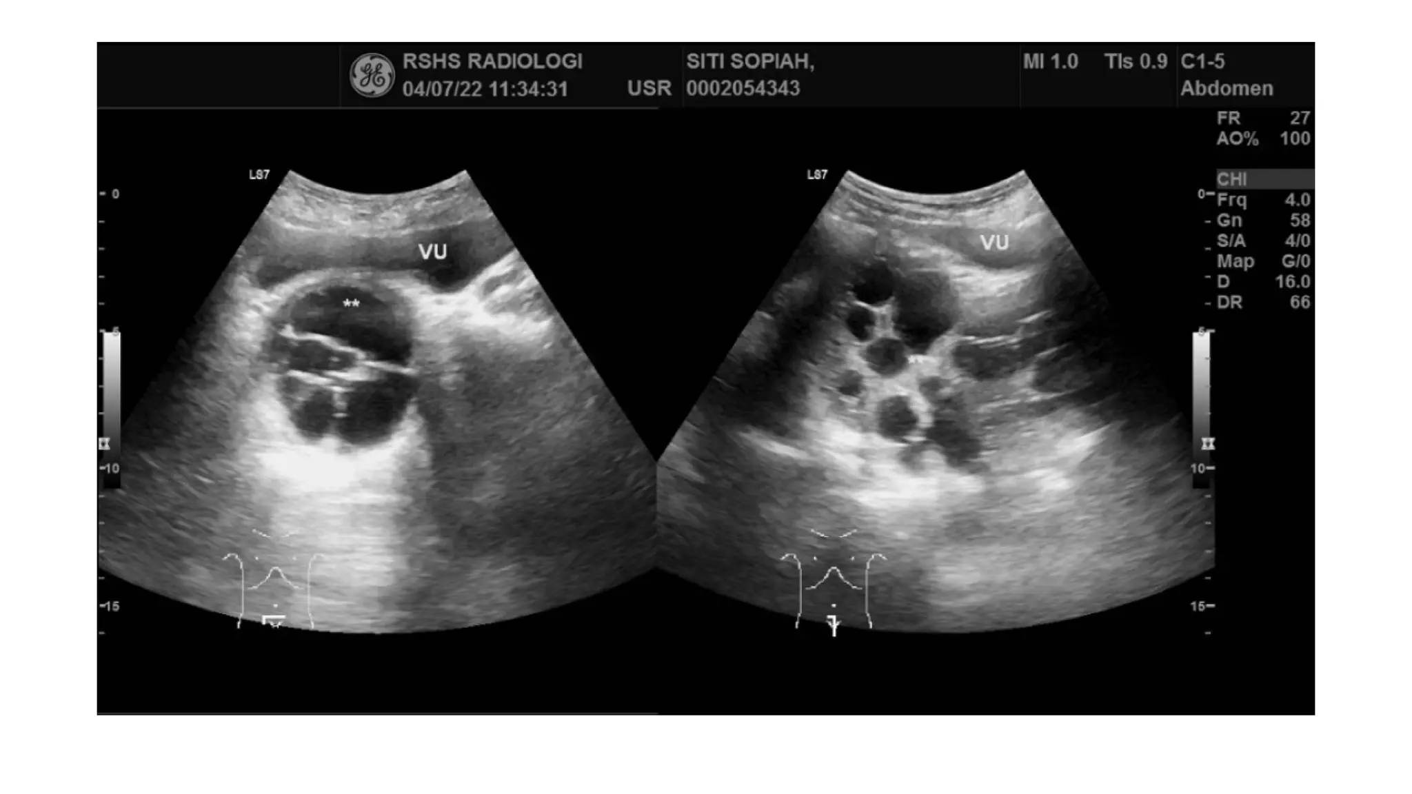 Multiple Hydatid Cyst mimicking ovarian cyst.pptx