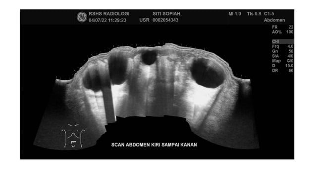 Multiple Hydatid Cyst mimicking ovarian cyst.pptx