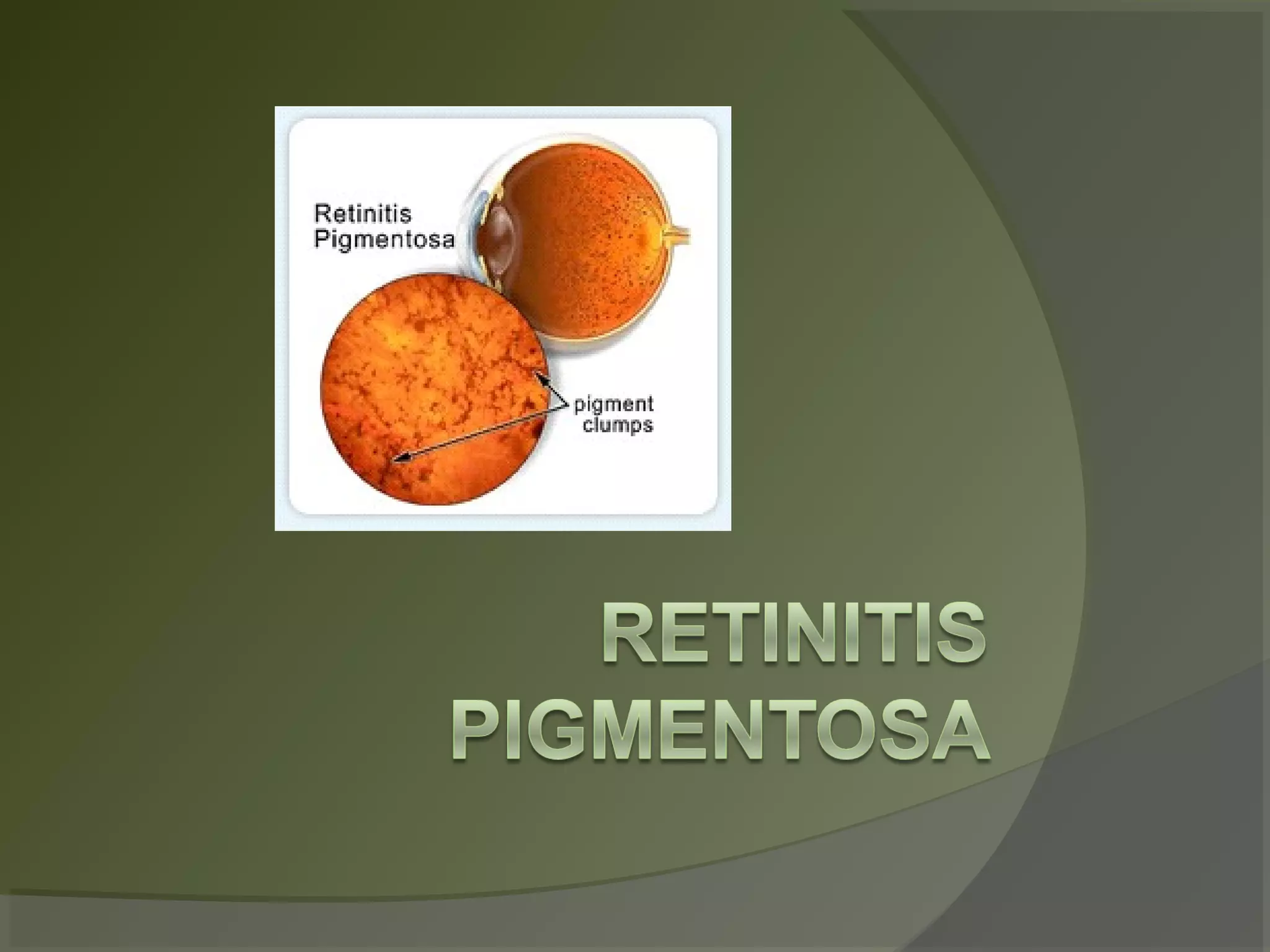 Nyctalopia & retinitis pigmentosa | PPT