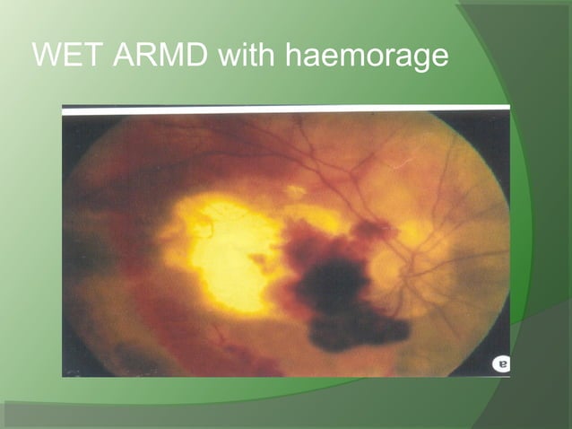 Nyctalopia & retinitis pigmentosa | PPT