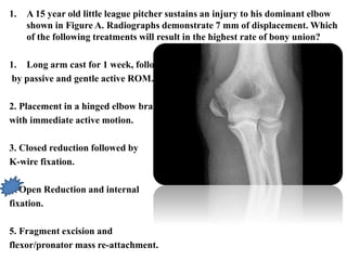 Medial Epicondyle Fracture