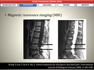 Presentasi Materi Nyeri Punggung Bawah.pptx