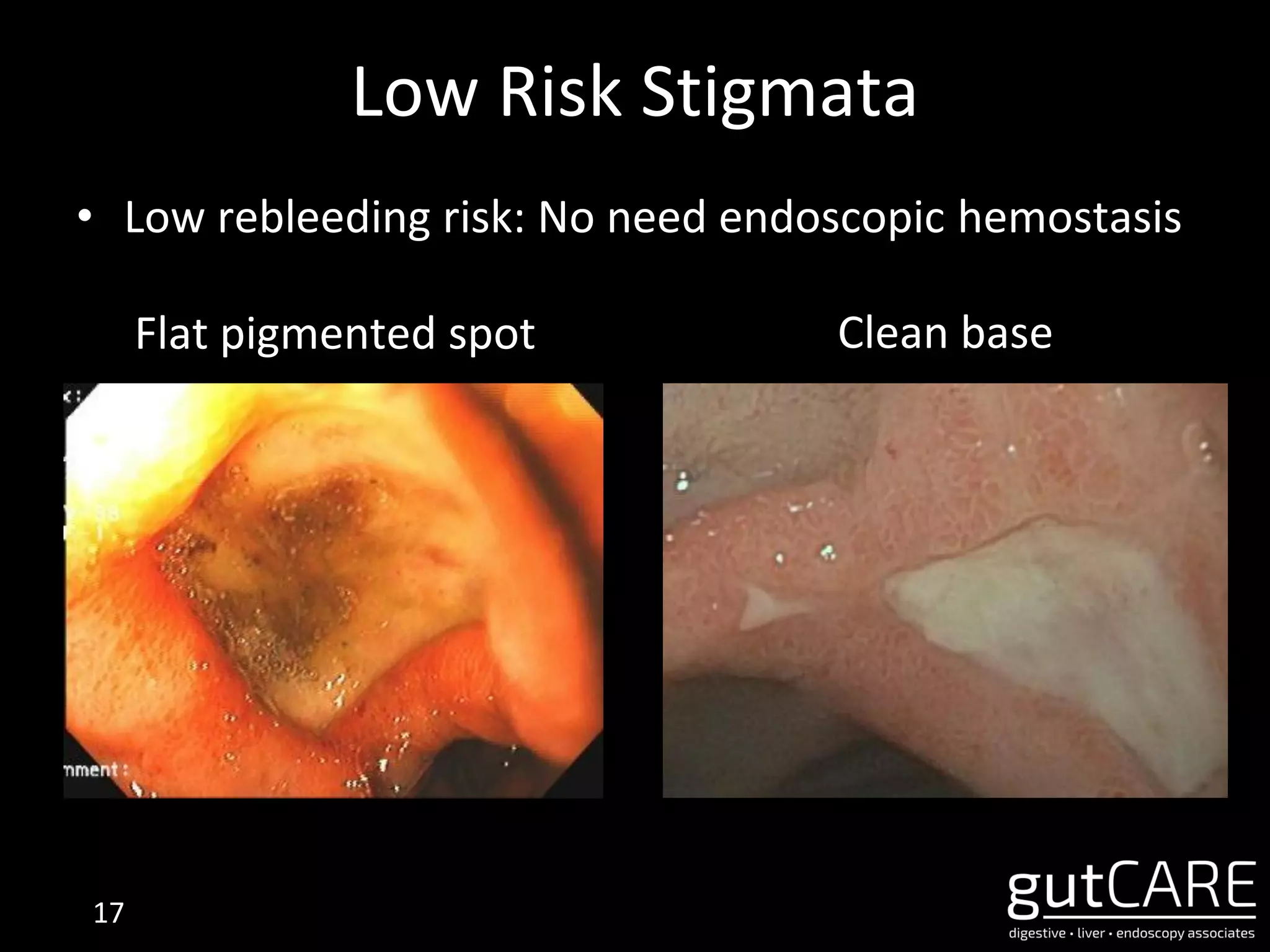 Endoscopic Hemostasis - for Endoscopy Nurses | PDF