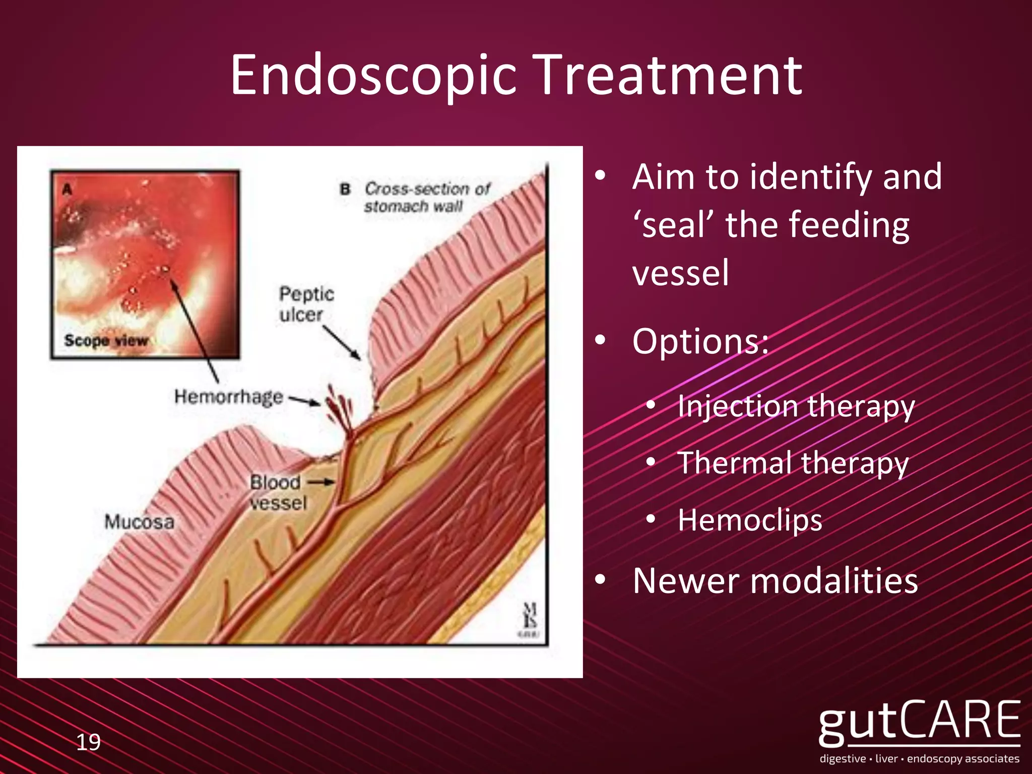 Endoscopic Hemostasis - for Endoscopy Nurses | PDF