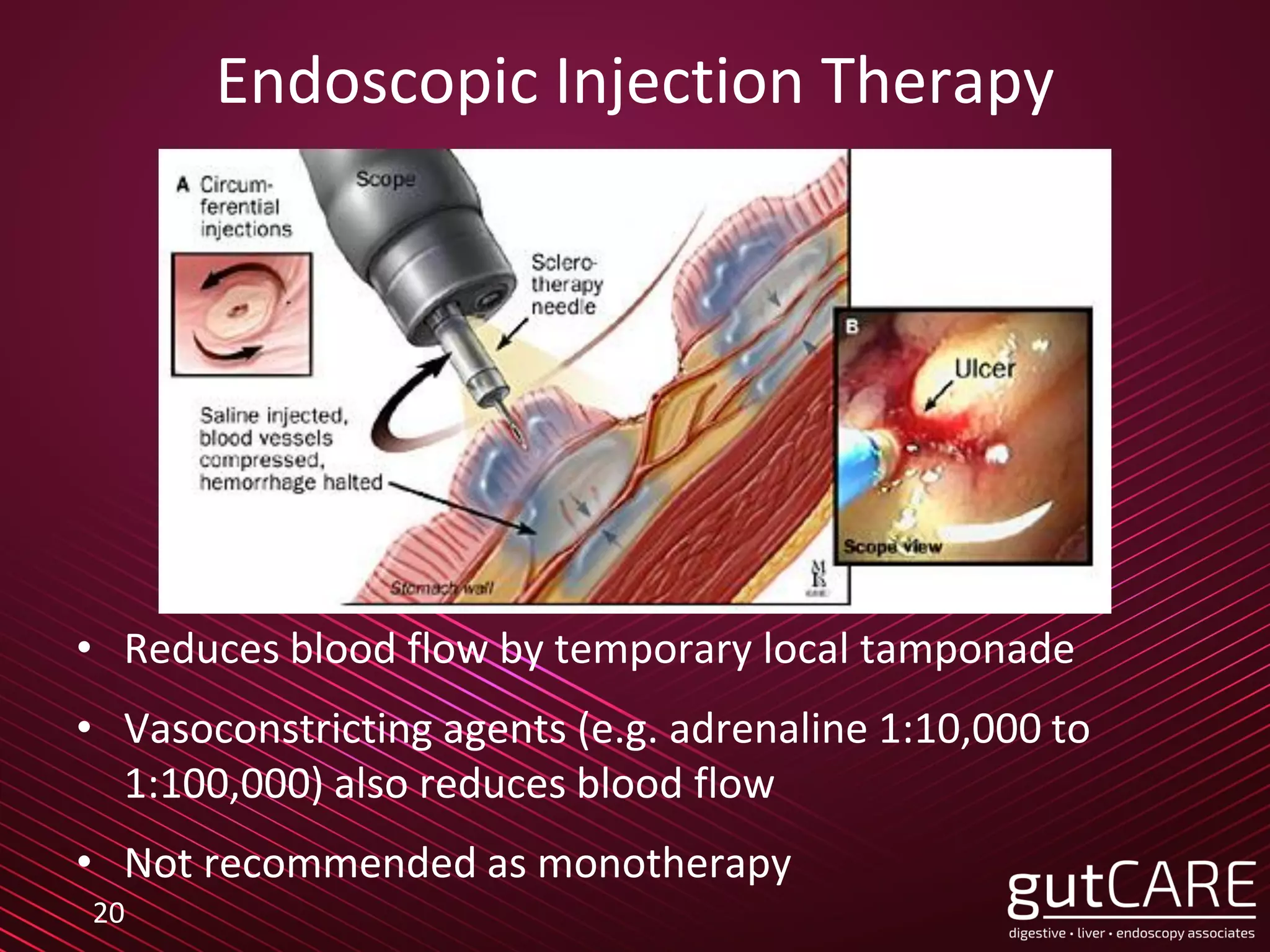 Endoscopic Hemostasis - for Endoscopy Nurses | PDF