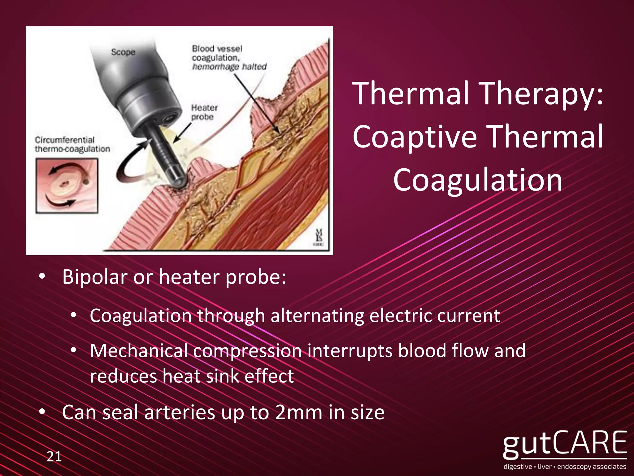 Endoscopic Hemostasis - for Endoscopy Nurses | PDF