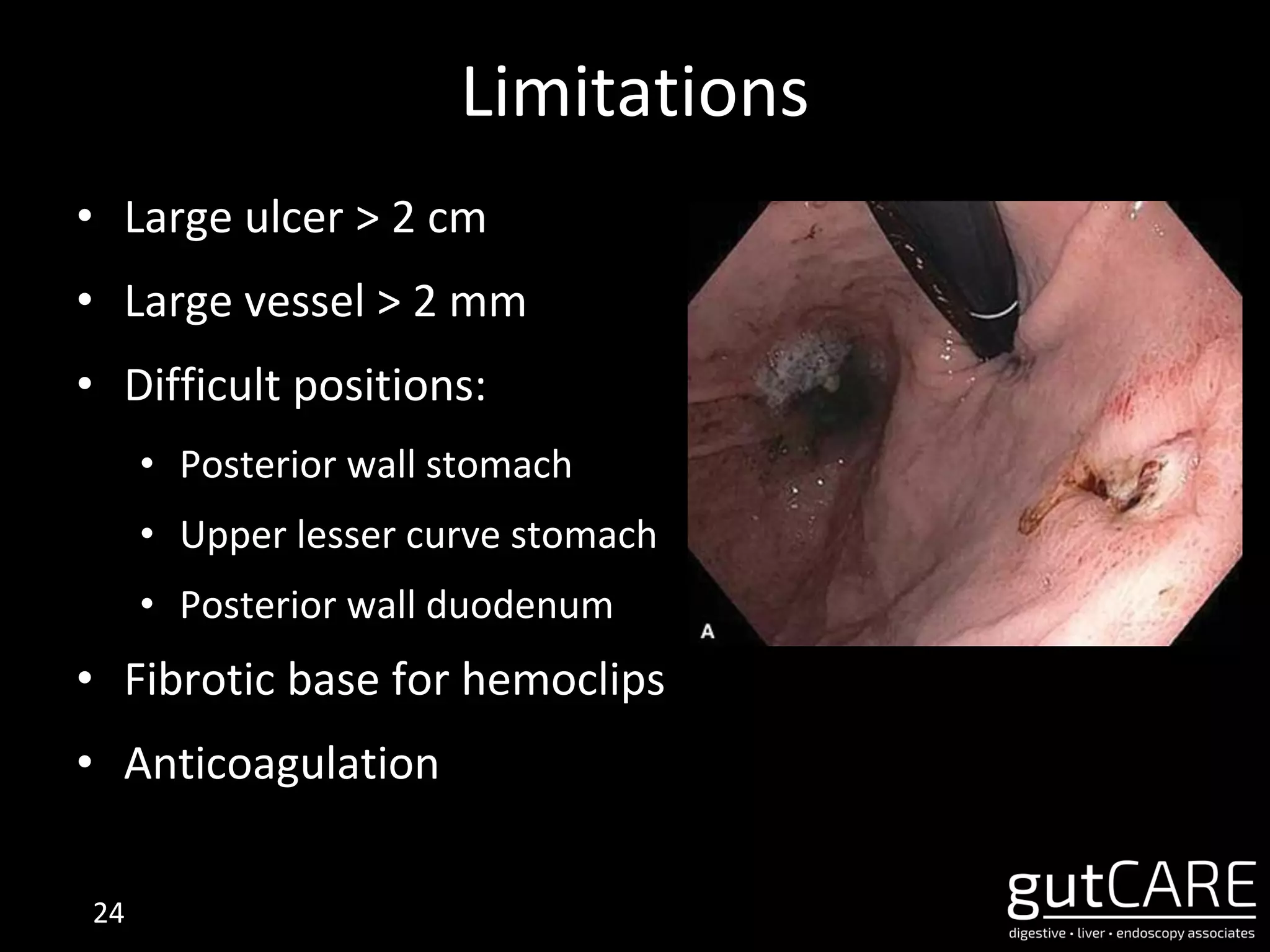 Endoscopic Hemostasis - for Endoscopy Nurses | PDF