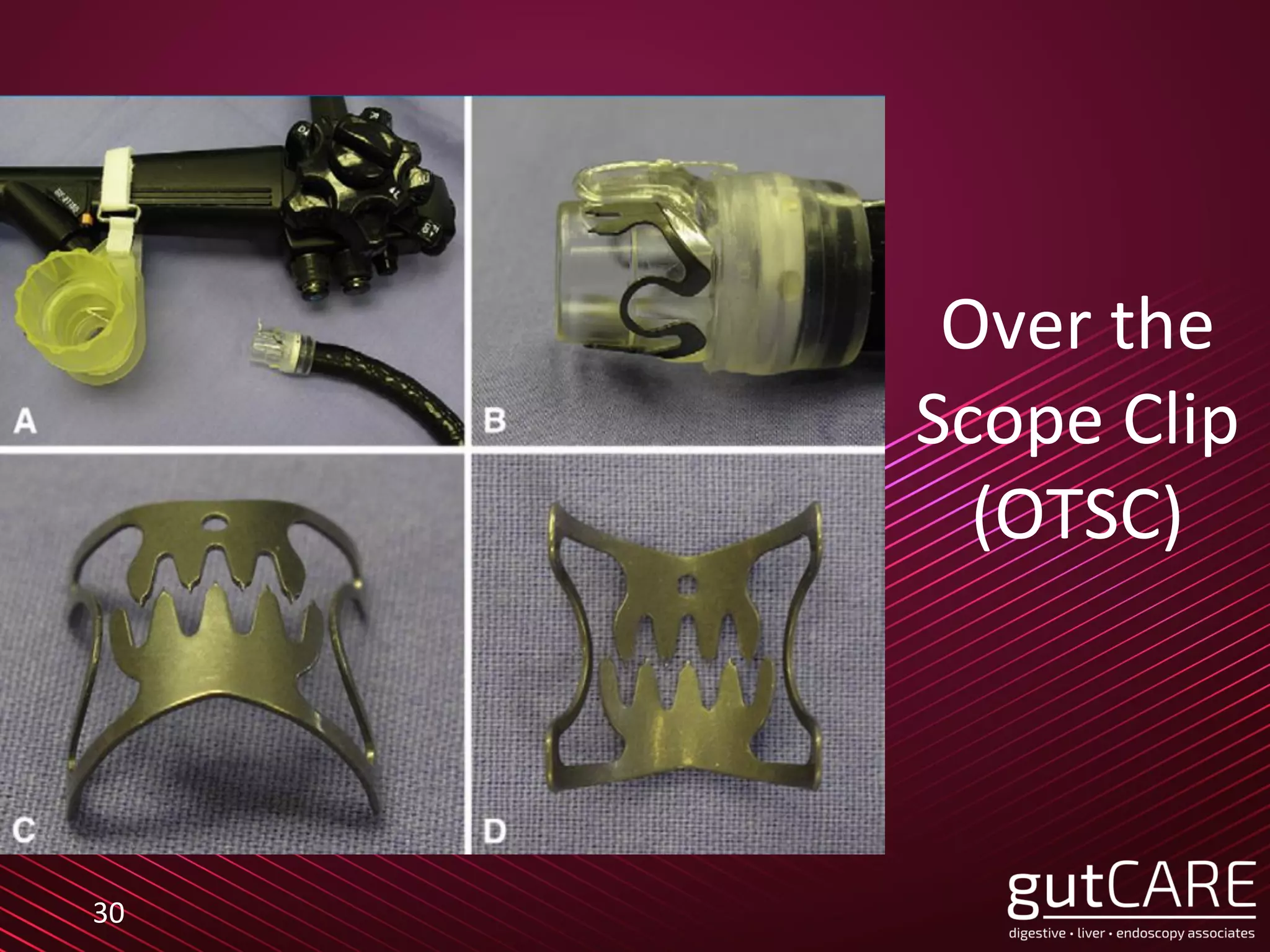 Endoscopic Hemostasis - for Endoscopy Nurses | PDF