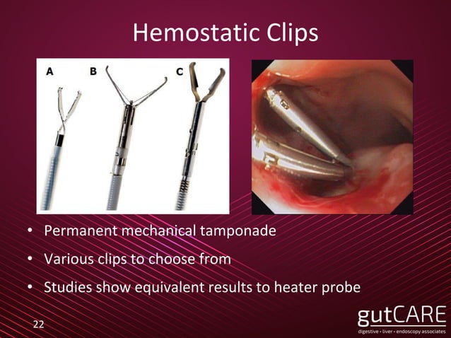Endoscopic Hemostasis - for Endoscopy Nurses | PDF