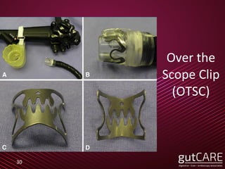 Endoscopic Hemostasis - for Endoscopy Nurses | PDF