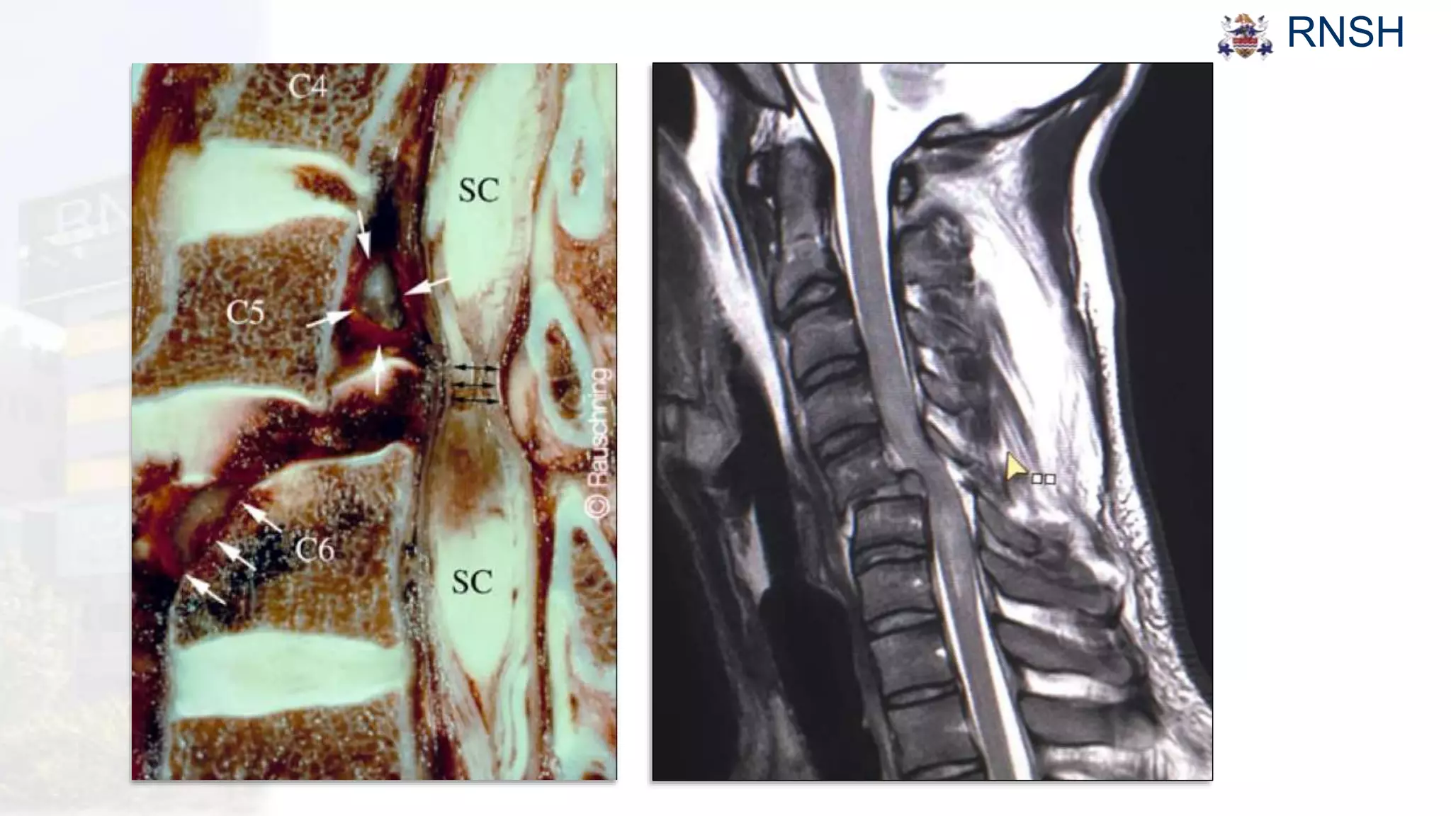 Contemporary management of spinal injury by Dr Jonathon Ball | PPTX