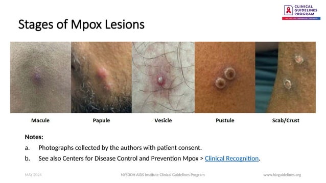 NYSDOH-AI-Prevention-and-Treatment-of-Mpox-slide-set_5-6-2024_HG.pptx