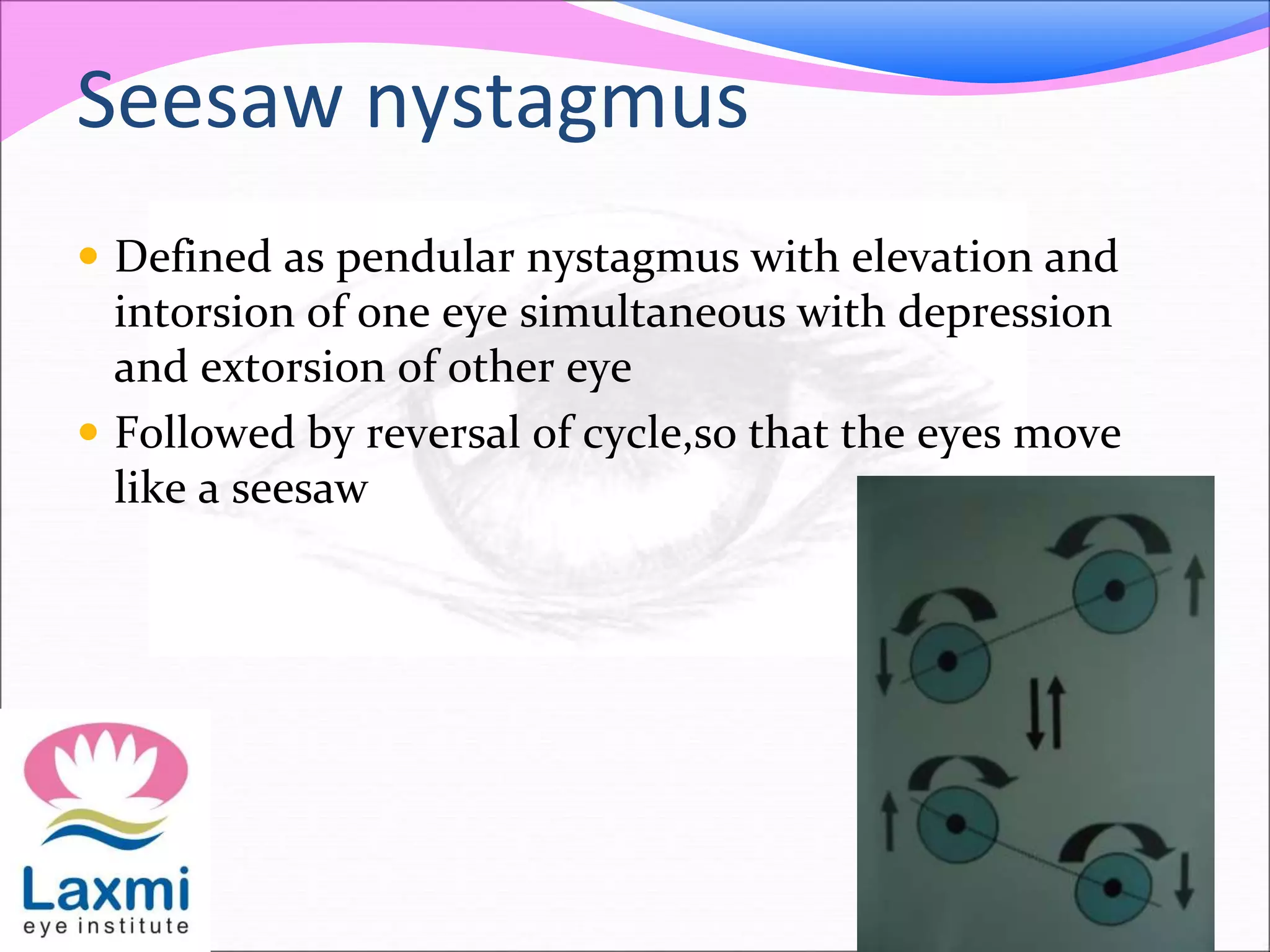Nystagmus | PPTX