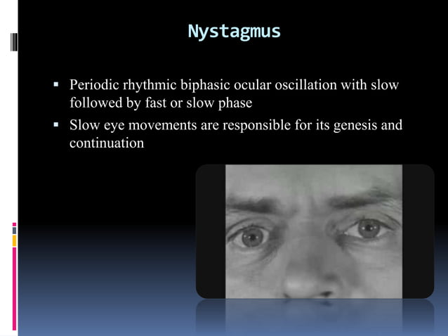 Nystagmus | PPTX
