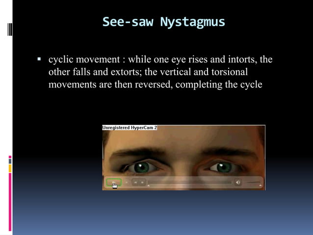 Nystagmus | PPTX