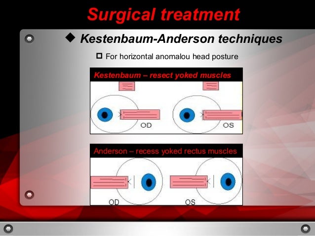 Nystagmus