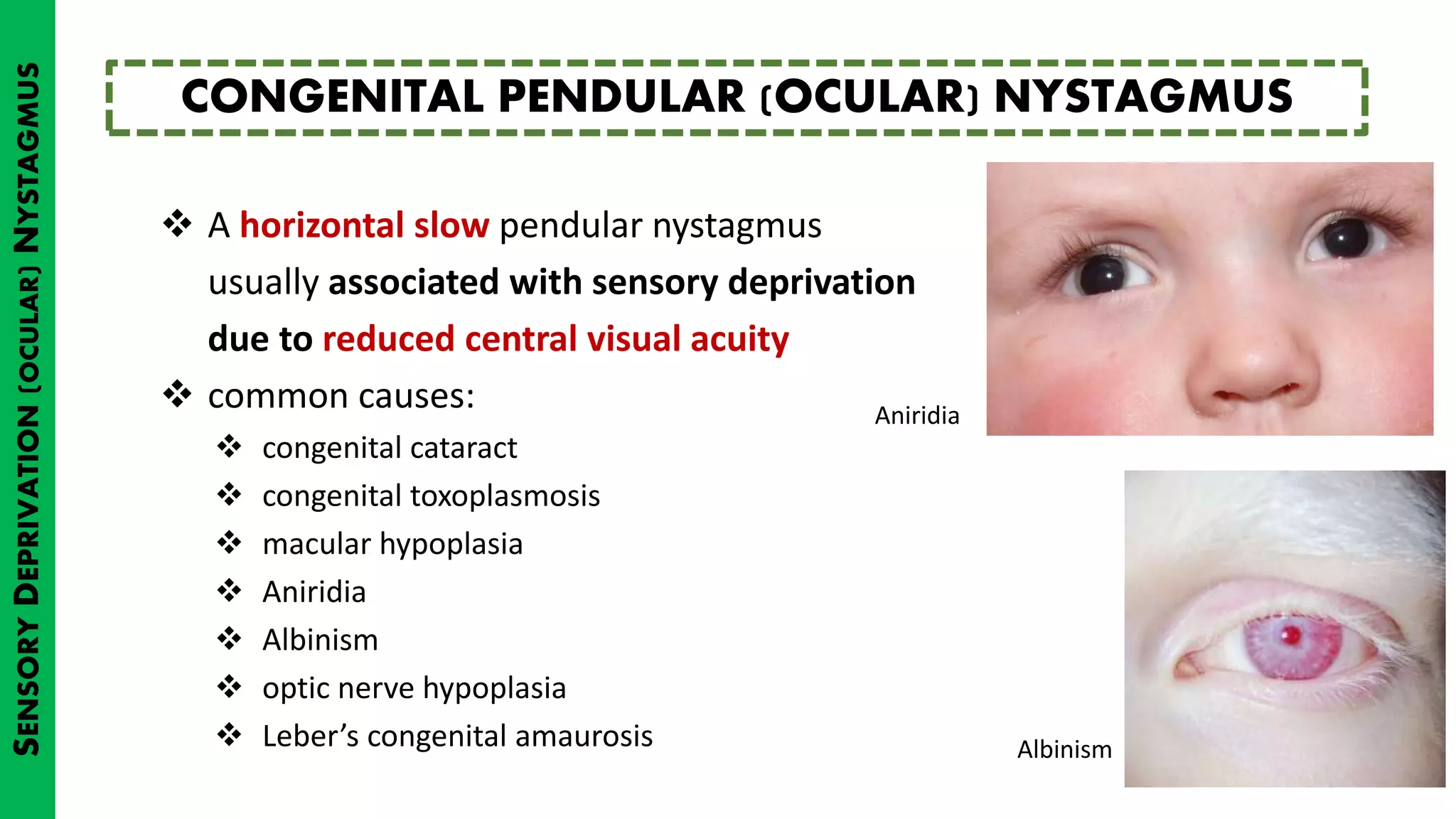 Nystagmus | PPTX
