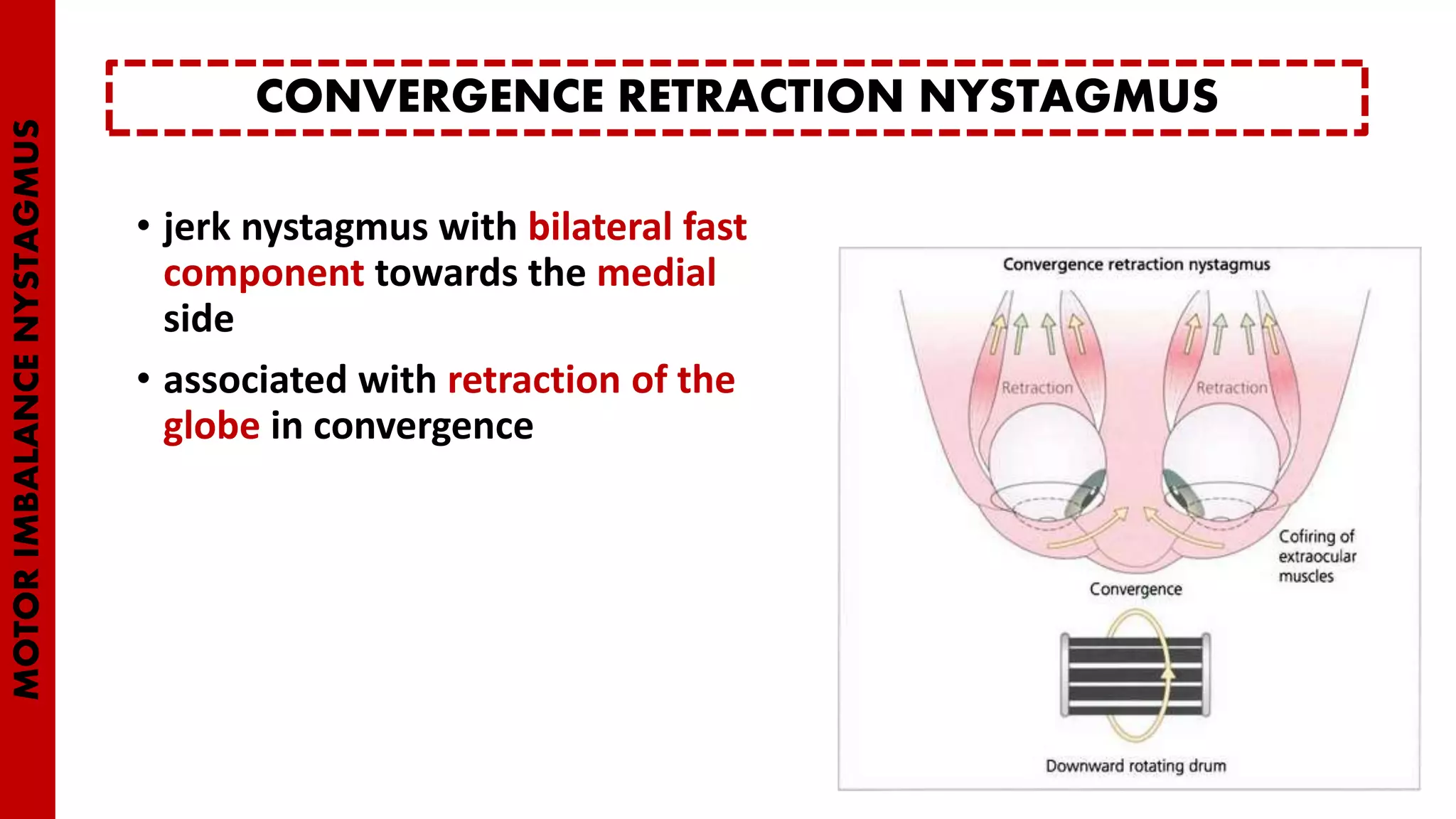 Nystagmus | PPTX