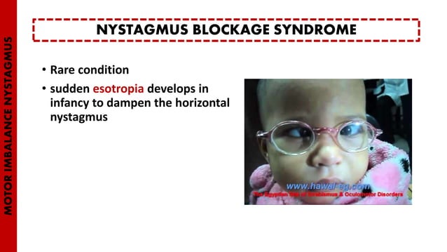 Nystagmus | PPTX | Eye and Vision Conditions | Diseases and Conditions