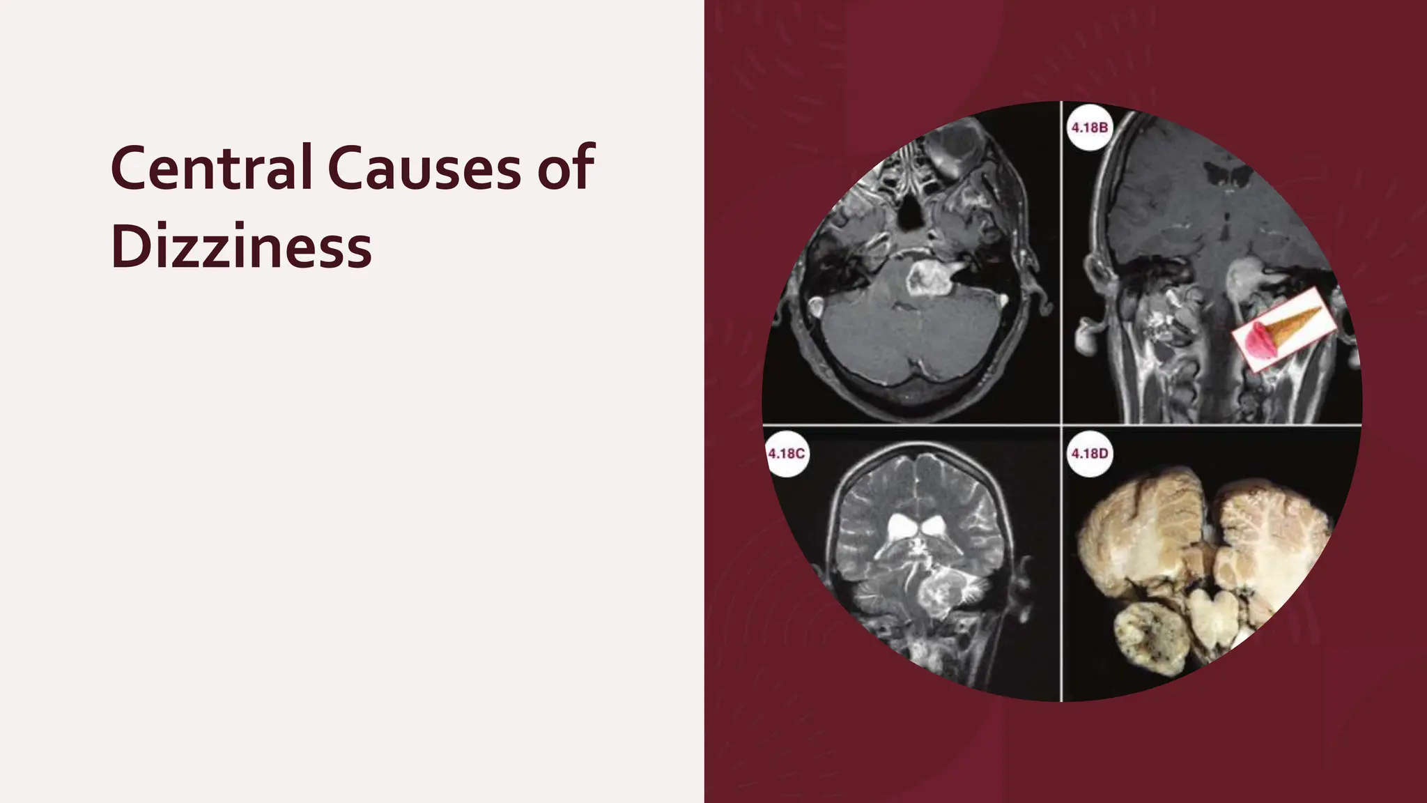 Vertigo and Nystagmus - Clinical approach part-2.pptx