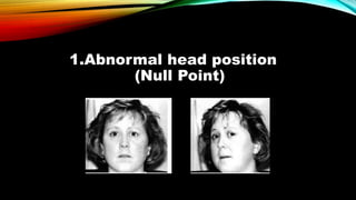 Nystagmus by ayasha | PPT