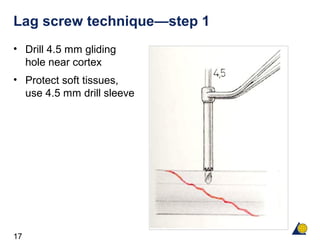 Design and function of surgical screws | PPT