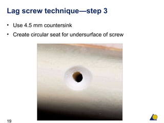 Design and function of surgical screws | PPT