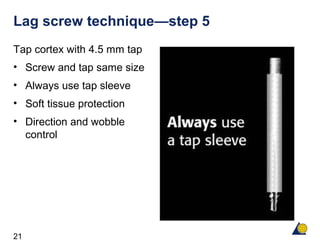 Design and function of surgical screws | PPT