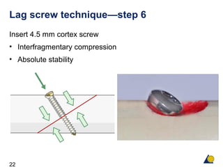 Design and function of surgical screws | PPT